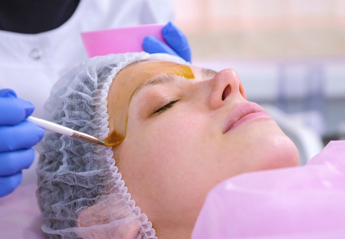 PEEL - Mesoskinline - Non invasiv mesoterapi